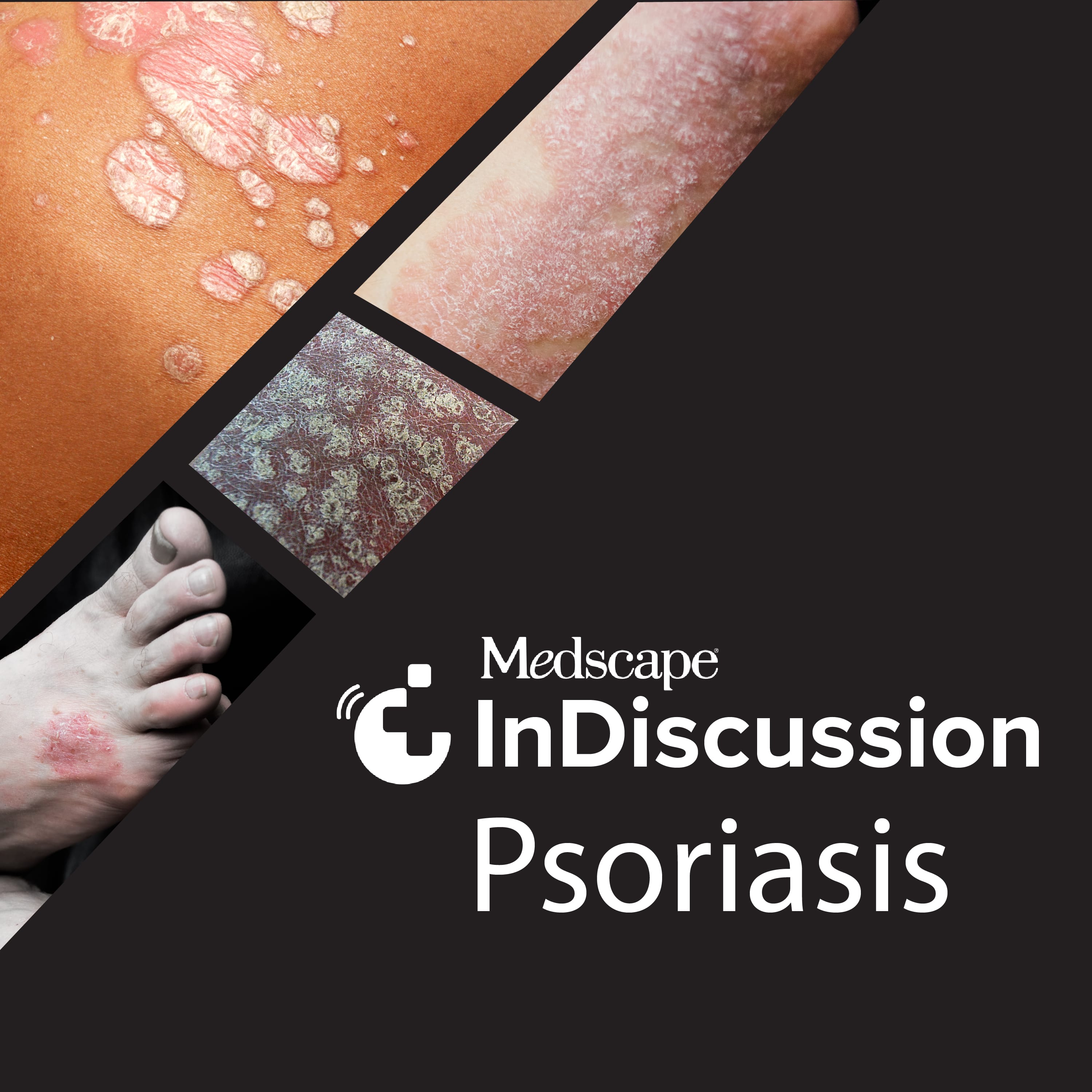 S2 Episode 1: Psoriasis Advocacy: A Model for Every Chronic Disease?