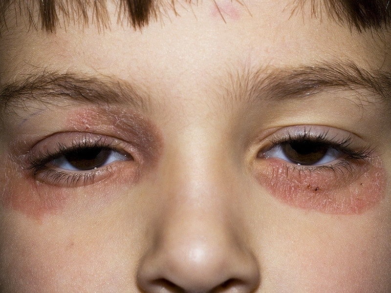 Study Proposes Best Predictive Diagnostic Criteria for Paediatric Psoriasis