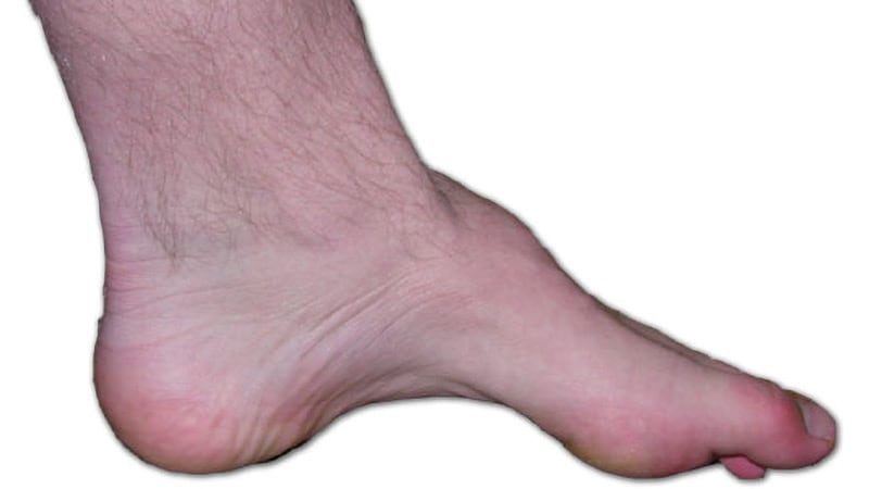 Treatment Is in Sight for Charcot-Marie-Tooth Disease