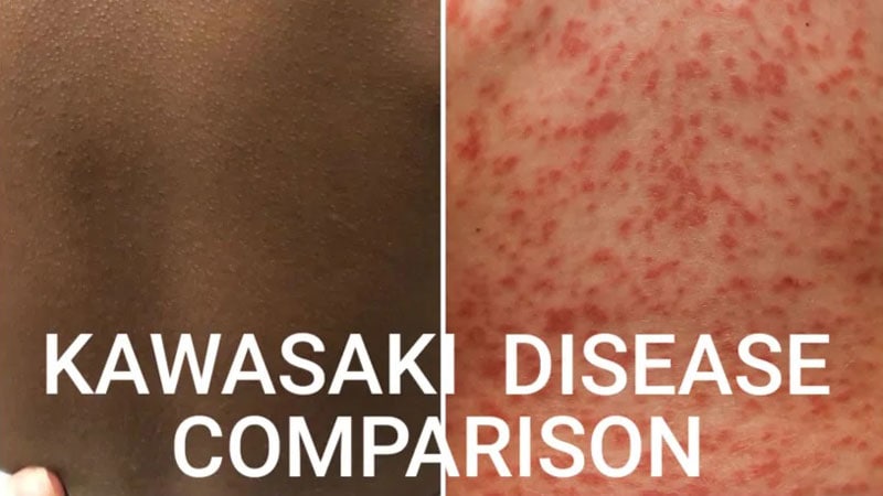 Medical Student Creates Handbook of Clinical Signs on Black and Brown Skin