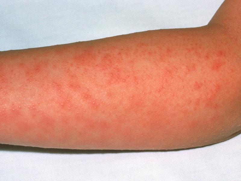 New Strep A Strain Linked to Scarlet Fever, and Sepsis
