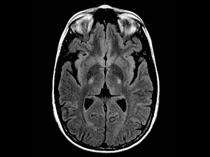 Should Routine Genetic Screening Be Offered to All ALS Patients?