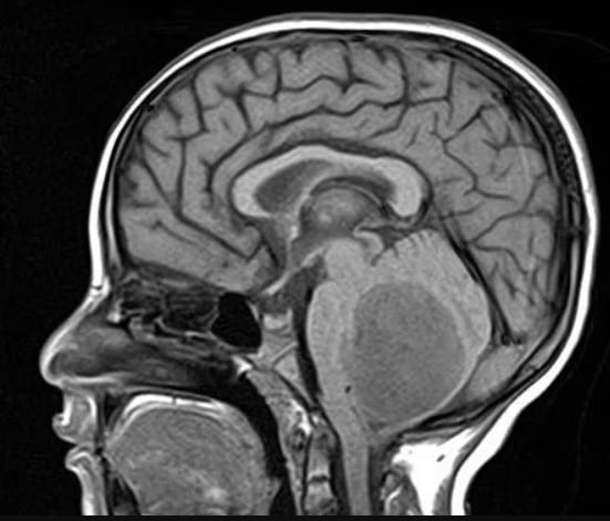 7-Year-Old With New-Onset Headaches and Vomiting